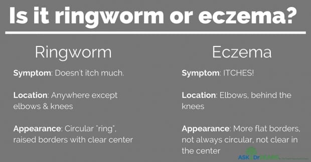Ringworm | Ask Dr Sears